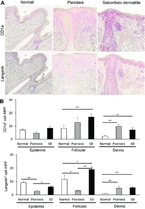 Distribution Of Dendritic Cells In Seborrhoeic Dermatitis Sd