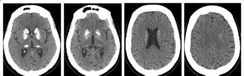Non Enhanced Axial Ct Sections Demonstrating Bilateral Nearly
