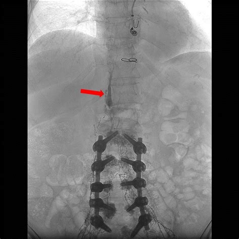 Diagnostic Intranodal Lymphangiography And Thoracic Duct Embolization