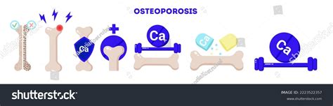 Osteoporosis Vector Illustrations Set Medical Orthopaedic Stock Vector