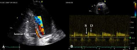 Doppler Examination In The PDA A Laminar Flow In The PDA Is Download Scientific Diagram