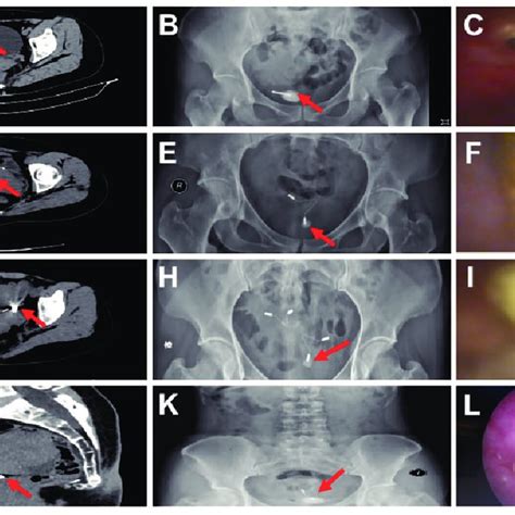 Open Pelvic Fracture With Massive Hemorrhage Initial Packing In The