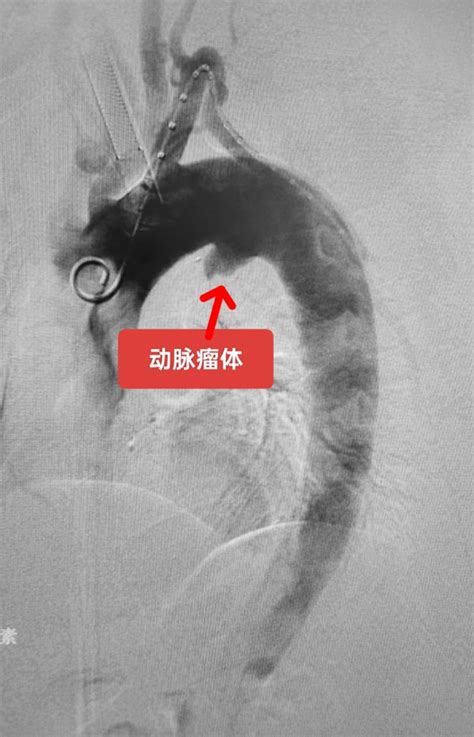 出类拔萃于我辈 主动脉支架体外开窗治疗胸主动脉瘤 技术前沿 新乡市第一人民医院