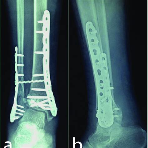 Limb Photograph Taken 6 Months After Orif Open Reduction And Internal Download Scientific