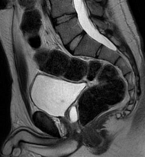 Prostatic Utricle Cyst