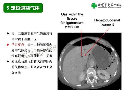 如何根据腹膜解剖确定穿孔位置腹腔内游离气体从哪来 医学界 助力医生临床决策和职业成长