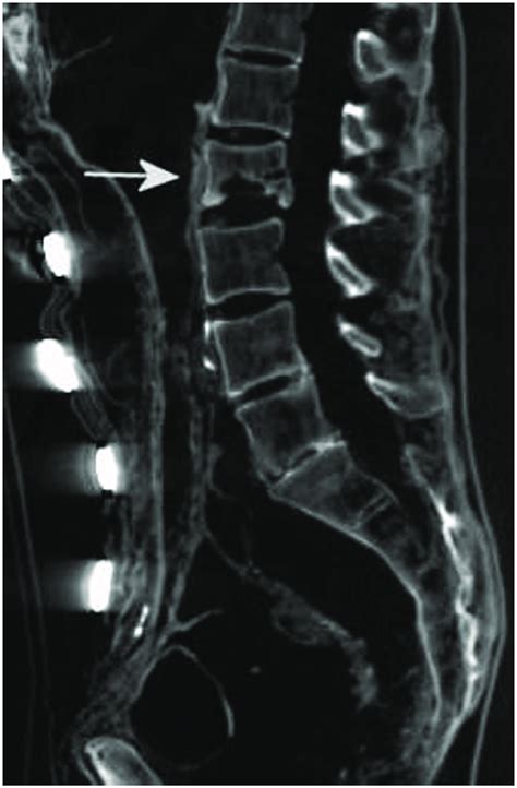 Ct Scan Of The Lumbar Vertebra Showing A Localised Irregularly Shaped