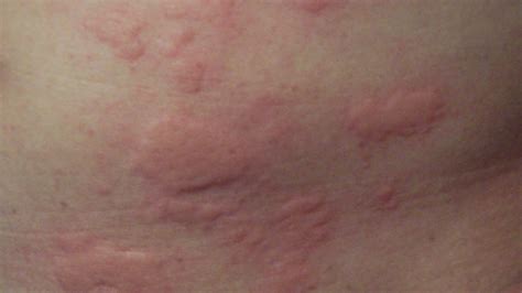 Pimplelike Bumps On The Scalp