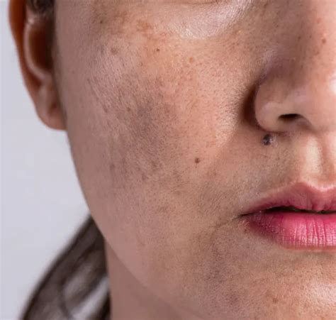 Pigmentation Treatments Citrine Clinic