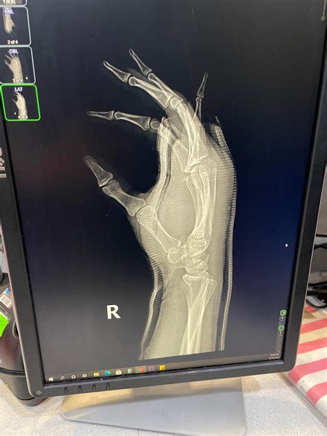I Broke My 4th Metacarpal And Dislocated My 5th One Rxrayporn