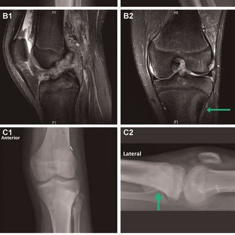 A Evidence Of Osteoblastic Type Osteosarcoma In The Proximal Tibia