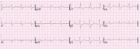 Right Bundle Branch Block And St Depression In V1 V3 Is That Normal