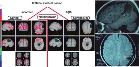 Mri And Normalization Types Of Case 1 Download Scientific Diagram