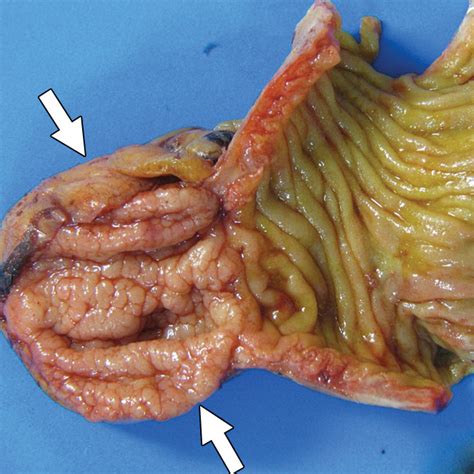 Meckels Diverticulum