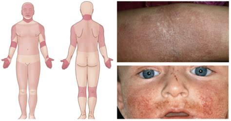 Clin Med Derm Gen Derm Lecture 2 Flashcards Quizlet