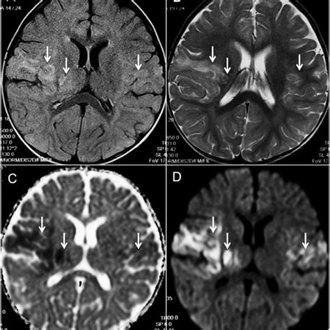 Scrofuloderma Tuberculosis Download Scientific Diagram