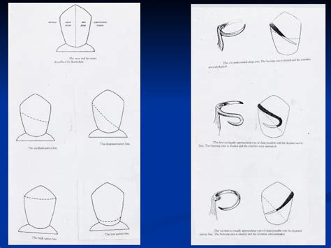 Basic Principles Of Removable Partial Denture Design Copy Ppt