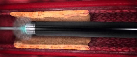 Best Doctor For Laser Atherectomy In Chennai