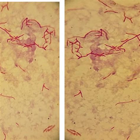 Brain Tissue Modified Kinyoun Stain With Branching Bacilli Download Scientific Diagram