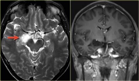 The Radiology Assistant Epilepsy Role Of Mri