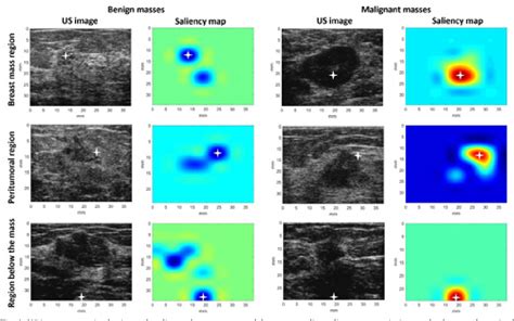 Figure 4 From Explaining A Deep Learning Based Breast Ultrasound Image