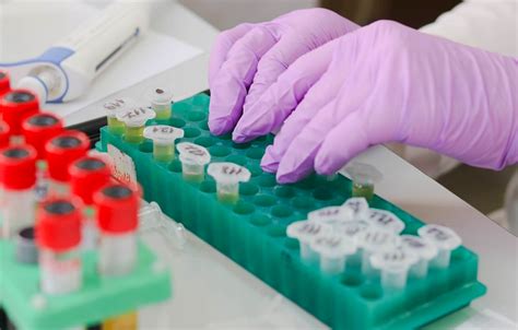 Scientists Find A Biomarker For Better Scleroderma Detection Clinical And Molecular Dx