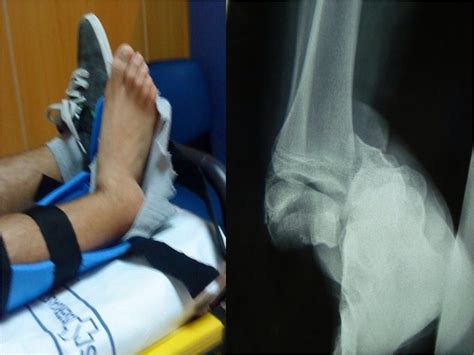 Fractura Cerrada Tobillo Fractura