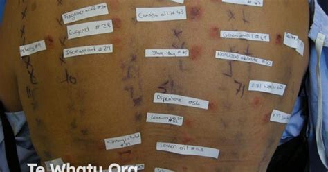 Patch Tests In Cosmetic Allergy Image