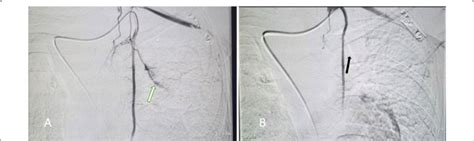 A Digital Subtraction Angiography DSA Image After Super Selective Download Scientific Diagram