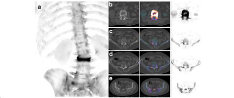 Example Of An XSPECT Bone Reconstruction Providing SPECT Images With Download Scientific