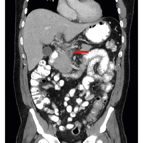 Hinchey 1b Sigmoid Diverticulitis Microperforation And Left Download Scientific Diagram