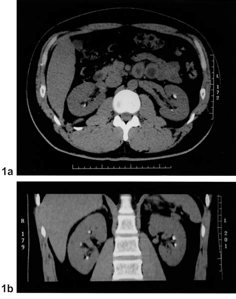 The Prevalence Of Nephrolithiasis In Patients With Primary Gout A