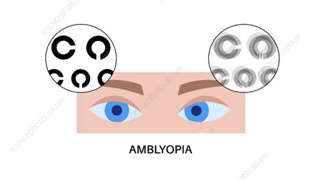 Amblyopia Illustration Stock Image F0445378 Science Photo Library