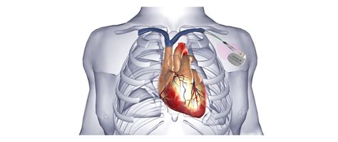 Pacemaker Implantation One Heart Cardiology