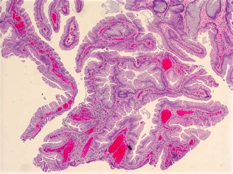 Pathology Outlines Traditional Serrated Adenoma