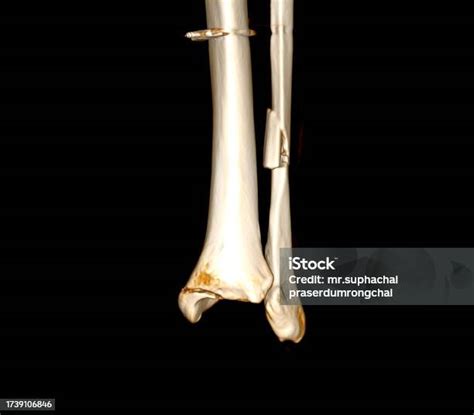 Ct 스캔 발목 관절 골절 경골 및 비골 뼈를 보여주는 3d 렌더링 이미지 3d 스캔에 대한 스톡 사진 및 기타 이미지 3d