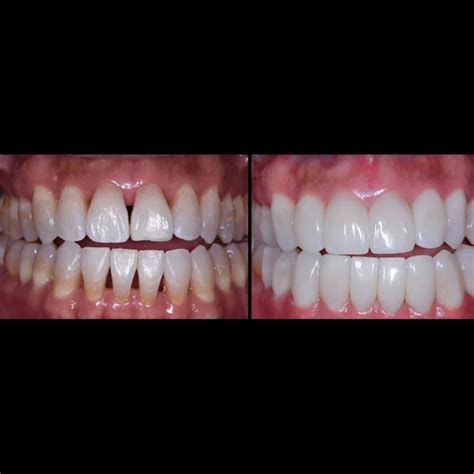 Black Triangle Teeth Before And After