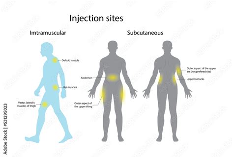 Illustration Of Biology And Medical Several Different Sites Can Support An Insulin Injection