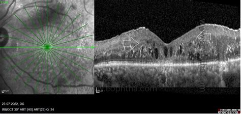 Diabetic Macular Edema Oct