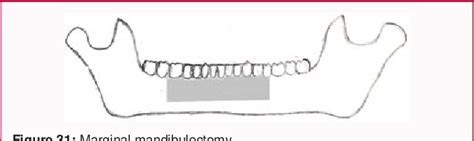Figure 4 From Classification Of Mandibulectomymandibular Defects