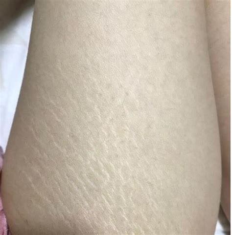 红色肥胖纹怎么去除 知乎