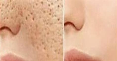 An Effective Way To Get Rid Of Clogged Pores Beauty4everything3