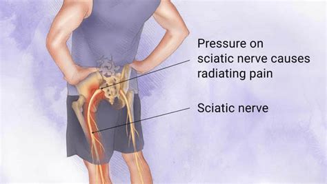 What Is Sciatica Gardens Wholistic Health Center