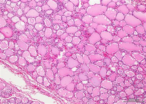 Normal Thyroid Gland