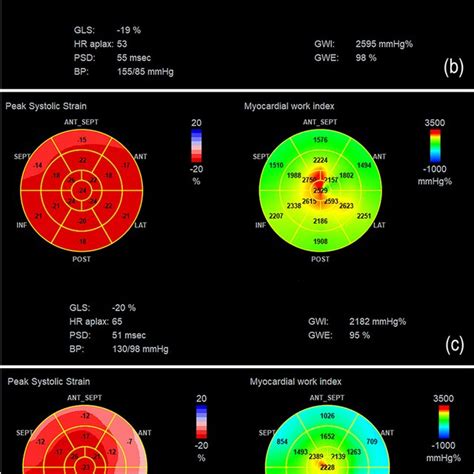 Roc Analysis For Hypertensive Lv Hypertrophy Api Apical Segments