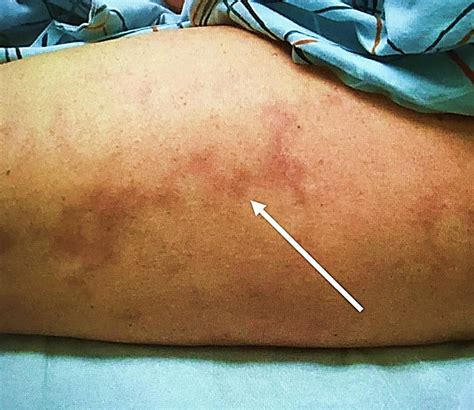 Arrow Pointing To A Large Ill Defined Violaceous Racemosa Patch On The