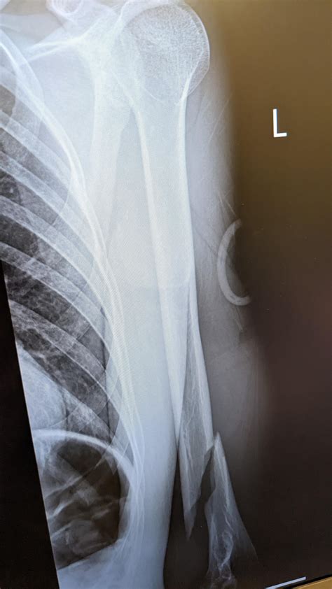 Distal Humerus Orif R Xrayporn