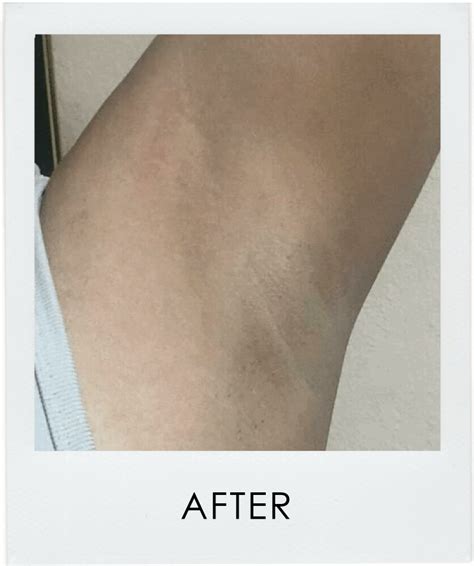 The 1 Trick To Stop Hyperpigmentation Kaia Naturals