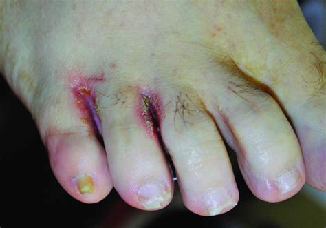 Macerated Toe At Sandra Moody Blog