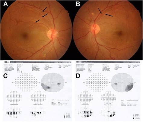 Localized Retinal Nerve Fiber Layer Defects In Hypertensive Retinopathy Ophthalmology Glaucoma